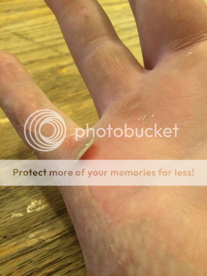 My first callus in 15 years = first lifting injury > Fitness > AR15.COM